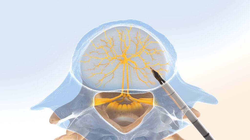 Intracept Procedure for Chronic Low Back Pain | Apex Spine